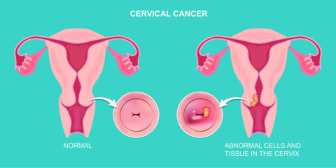 What is Cervical Cancer: Causes, Symptoms & Treatment | PharmEasy