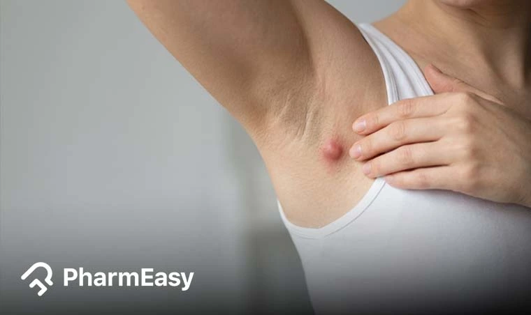 Lump Under Armpit? Learn Its Causes and Simple Home Remedies | PharmEasy