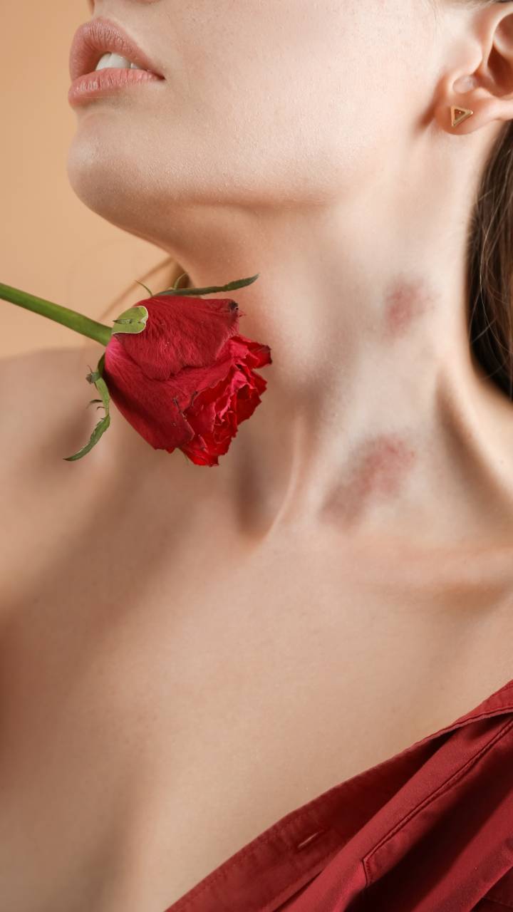 Know How To Get Rid of a Hickey At Home