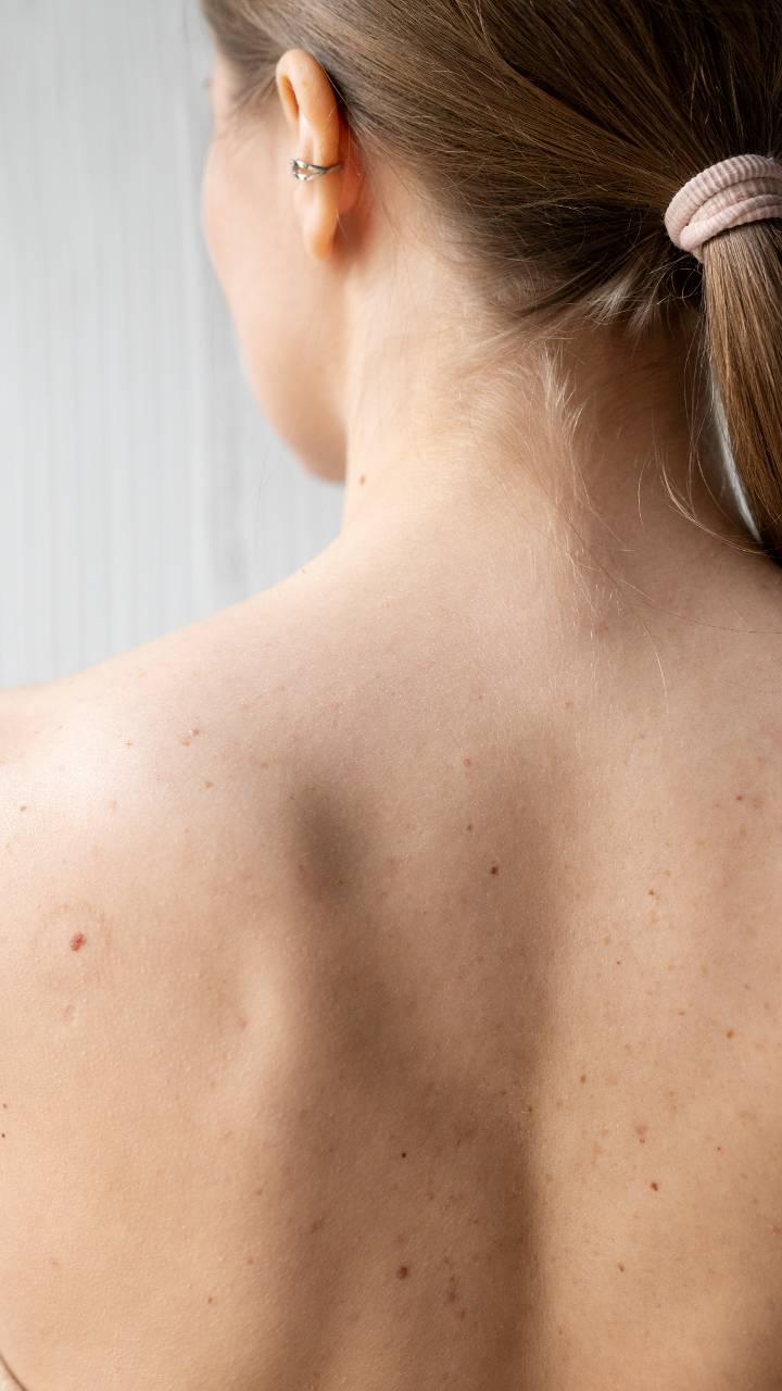 How To Get Rid of Back Acne